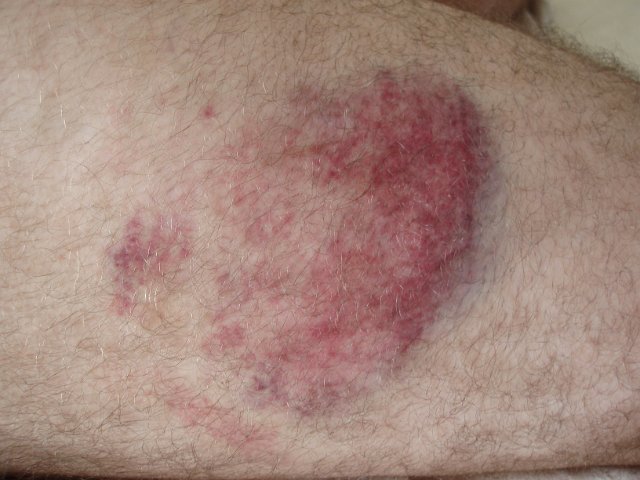 bruise | Free backgrounds and textures | Cr103.com