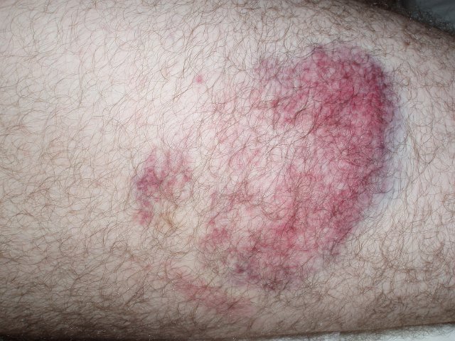 bruised arm | Free backgrounds and textures | Cr103.com